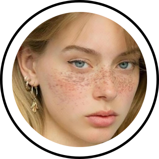 freckles | Search Snapchat Filters and Lenses