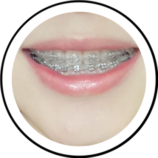 braces | Search Snapchat Creators, Filters and Lenses